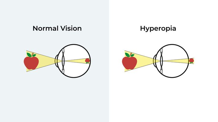 What is Hyperopia? Causes & Treatment of Long Sightedness